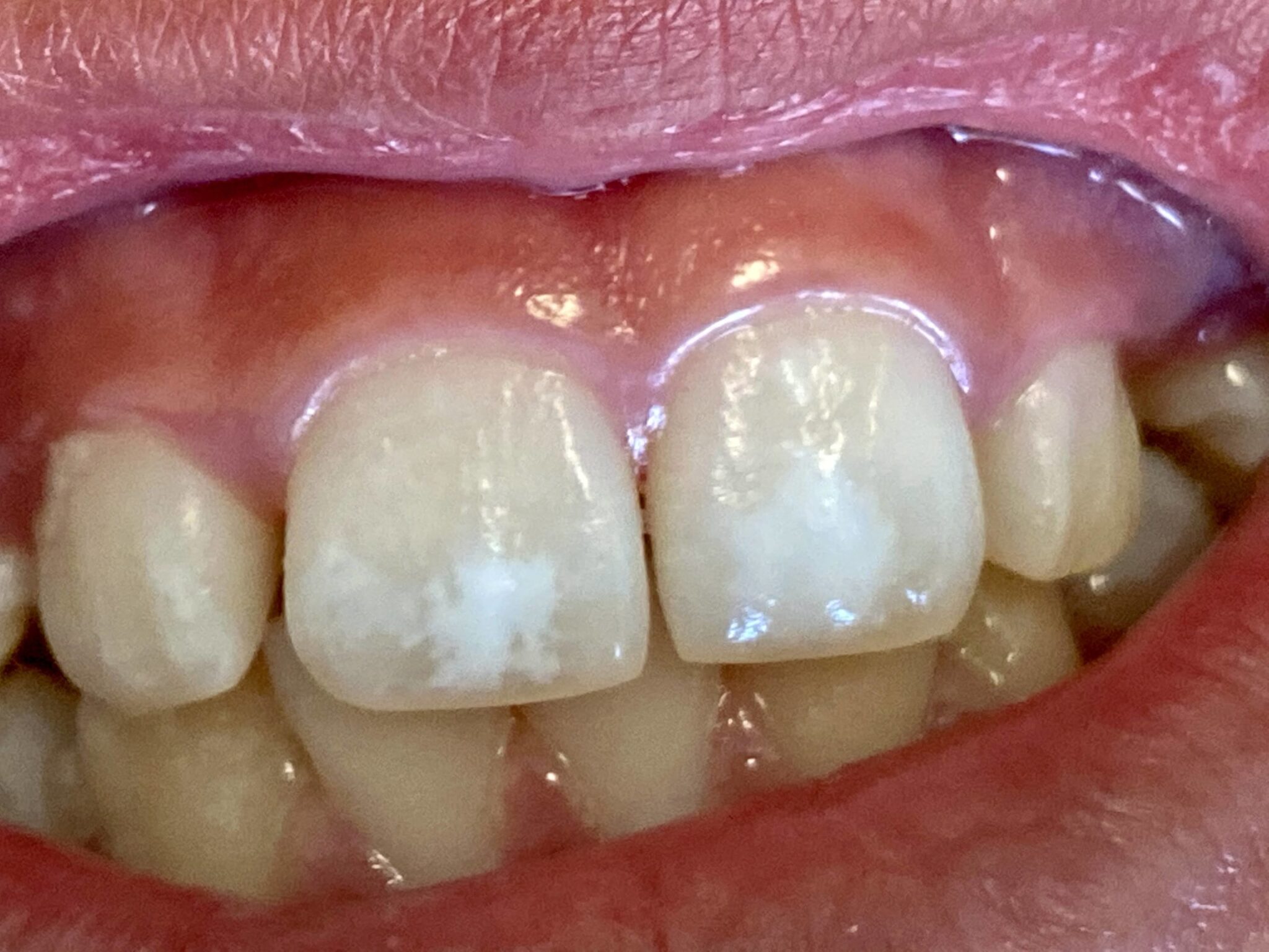 Icon Treatment for White Spot Lesions – Mickleham Dental